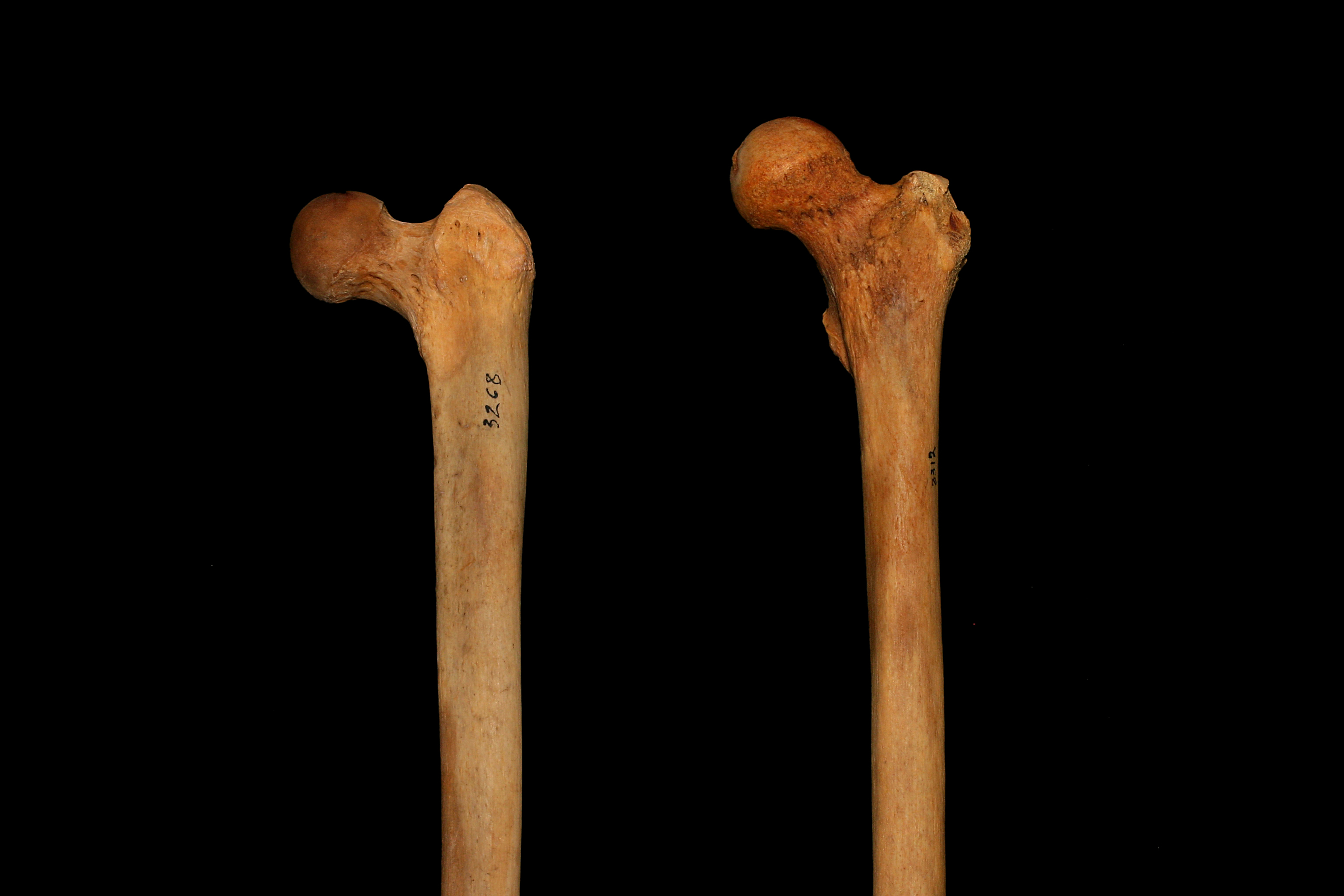 Not All Bones Are Created Equal Not Everyone Splits The Same Www 